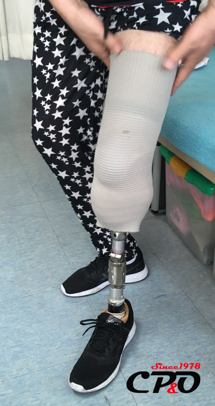 의족 /유압식 발목관절 의족발 에쉴론(Echelon Foot)/맞춤형 실리콘 라이너 슬리브 타입 무릎 아래 절단 다리의족 ...