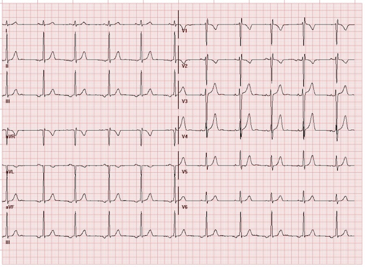 Ectopic atrial rhythm : 네이버 블로그