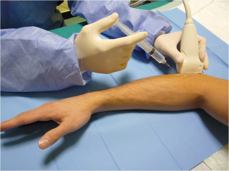 Ultrasound (US) guided interventional procedures around the elbow ...