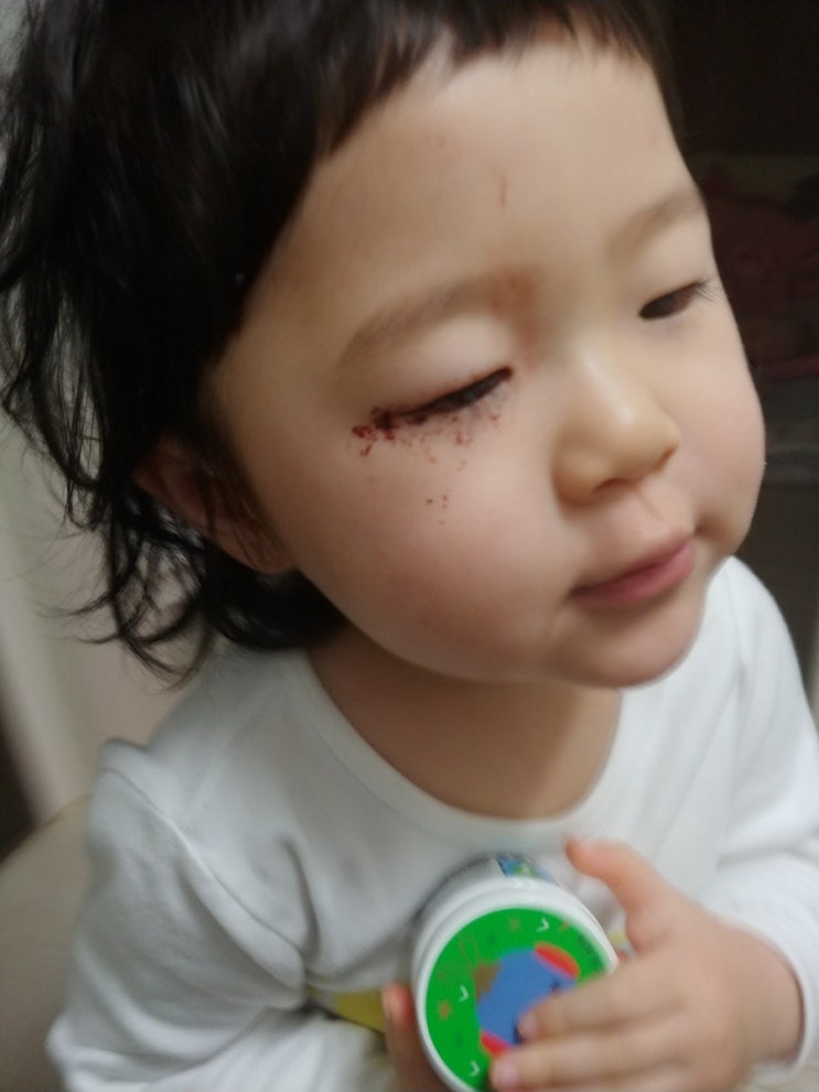 21개월 양쪽 눈 다래끼로 결국 병원행 가장 좋은 다래끼 치료방법은 바로 병원에 가는 것 네이버 블로그