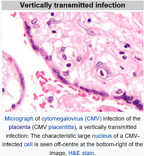 vertically transmitted disease / congenital infection : 네이버 블로그