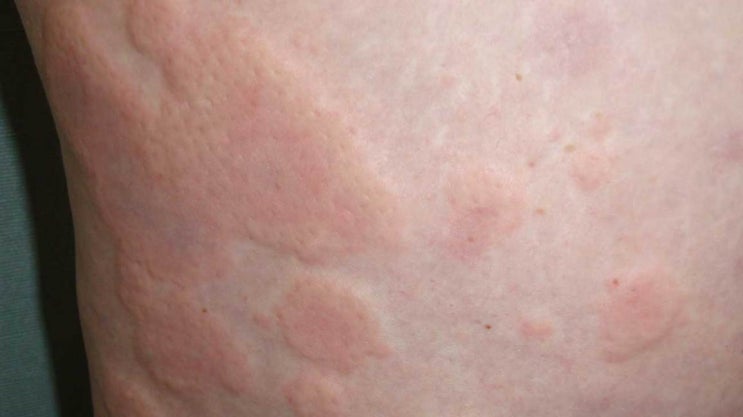 만성 자발 두드러기 (CSU, chronic spontaneous urticaria) : 네이버 블로그
