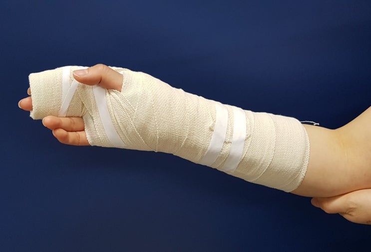 Short Arm Radial Gutter Splint : 네이버 블로그