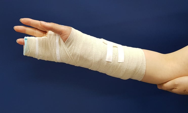 Short Arm Ulnar Gutter Splint : 네이버 블로그