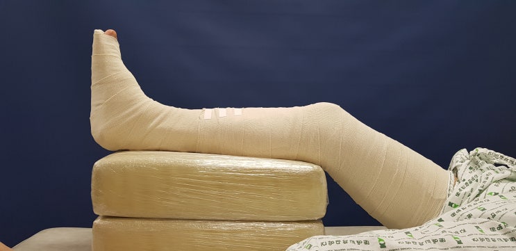 Long Leg Splint : 네이버 블로그