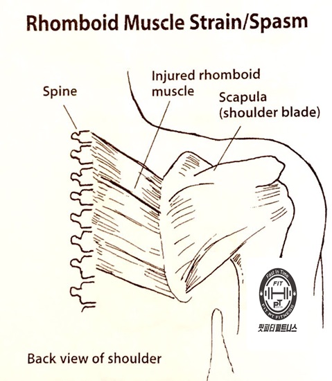 Rhomboid Muscle Strain or Spasm(능형근염좌/능형근좌상) 의 발생, 증상, 진단, 치료 [핏피티 ...