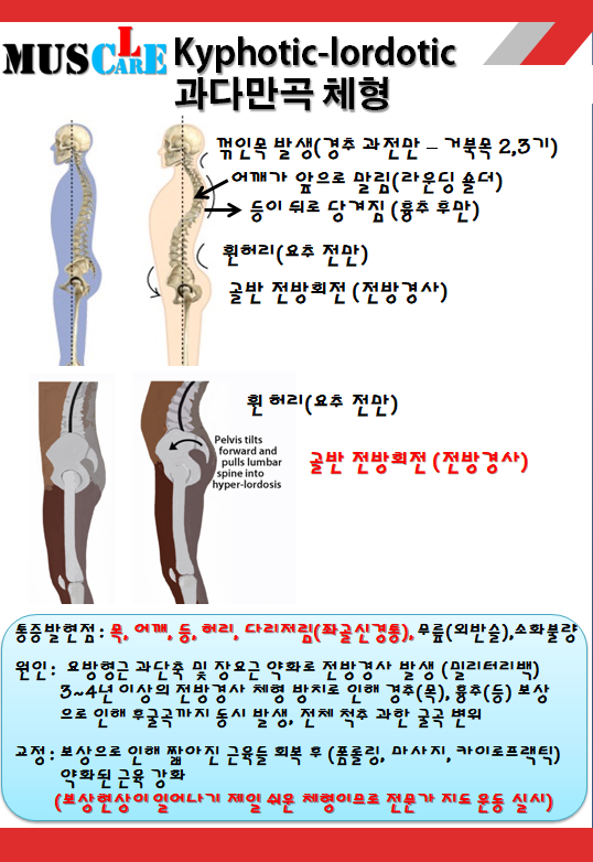 kyphotic lordotic 척추과다만곡 체형 교정 운동처방 「강남 체형교정센터 문현일 머슬케어」 : 네이버 블로그
