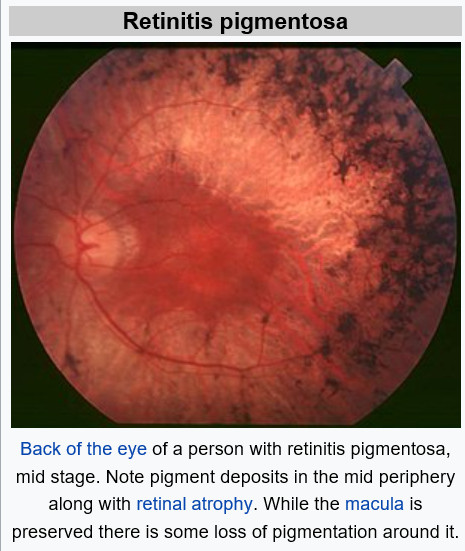 retinitis pigmentosa : 네이버 블로그