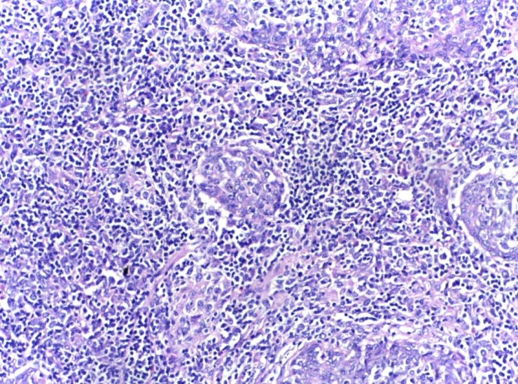 Mikulicz's disease : 네이버 블로그