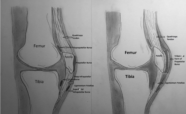 prepatellar bursitis : 네이버 블로그