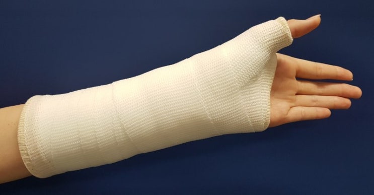 Short Arm Thumb Spica Cast : 네이버 블로그