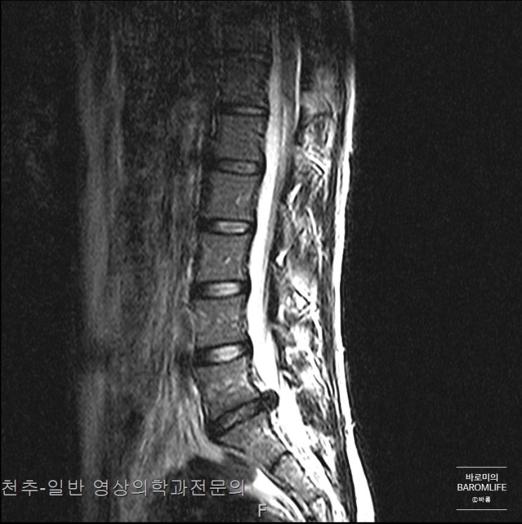 허리 통증때문에 시작한 SNPE / 허리디스크에 좋은 운동 : 네이버 블로그