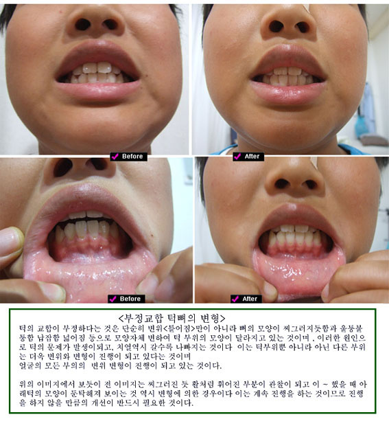 턱관절장애상담해주세요 부정교합 턱비대칭 턱관절소리 얼굴비대칭 안면비대칭 턱틀어짐 턱통증 대진당 기치료원 네이버 블로그