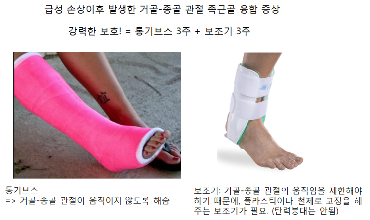 족근골 융합족근골 결합 2 거골 종골 족근골 유합의 비 수술치료는 무엇이고 수술은 언제 어떻게 하나요 족부 정형외과
