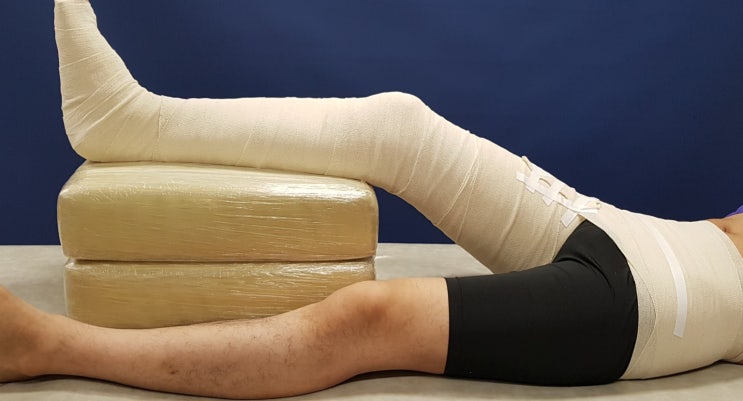 High Long Leg Splint : 네이버 블로그