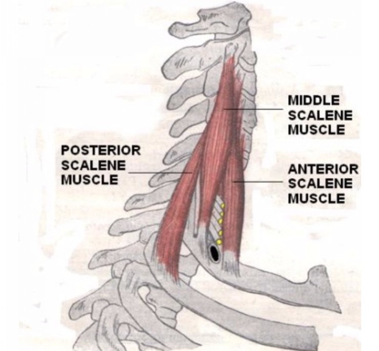 사각근(Scalene)/ 목갈비근 해부학/ 사각근증후군/흉곽출구증후군/ 목디스크/ 목스트레칭/ 목운동/ 목통증, 팔통증, 손저림 ...