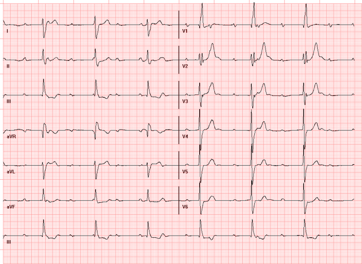 완전 방실 차단(블록), 혈역학적으로 안정한 경우, Third degree (complete) atrioventricular ...