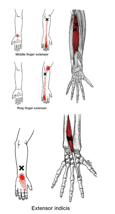 시지신근의 통증유발점(Extensor Indicis Trigger Point Diagram), 3,4번째 손가락 등쪽 통증과 ...