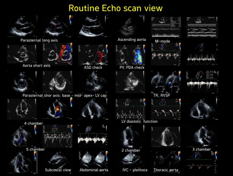 Routine Echo scan view : 네이버 블로그