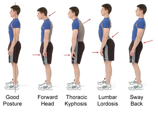 [하남라임필라테스]요추전만Lordosis에 관하여 : 네이버 블로그