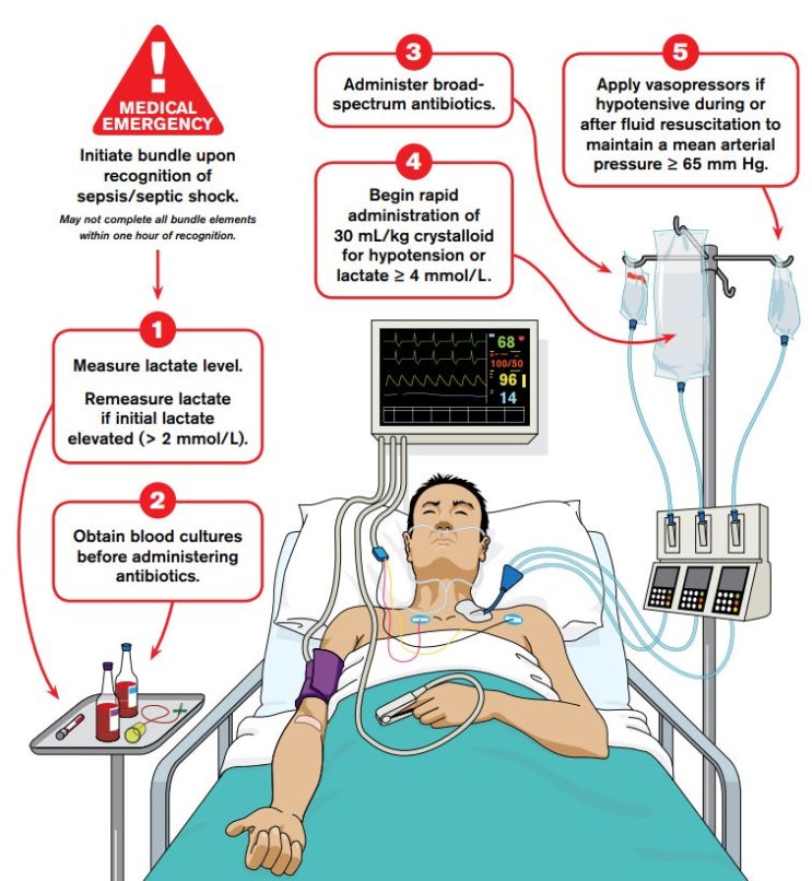패혈증 1시간 꾸러미 업데이트 - The Surviving Sepsis Campaign Bundle: 2018 Update ...
