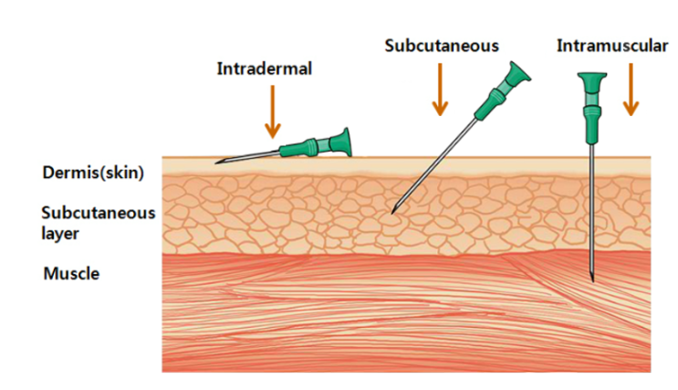 [간호학]피내주사(intradermal injection) : 네이버 블로그