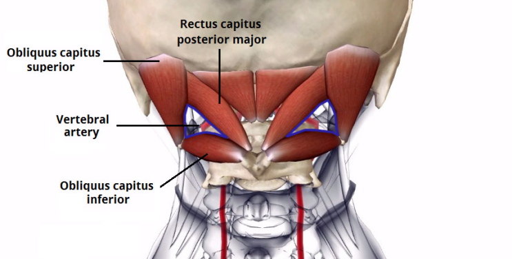 관자놀이 통증과 안압증가의 원인 후두하근 트리거포인트 Suboccipital Muscles Trigger Point 『역삼