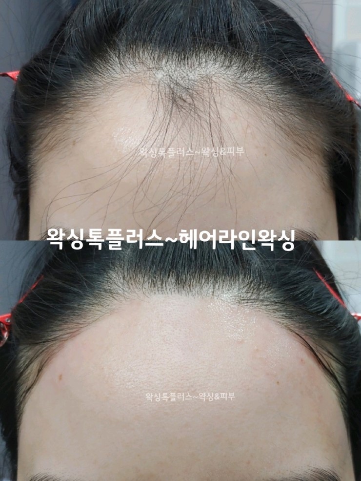 왁싱톡플러스 광양왁싱 왁싱톡플러스에서 헤어라인왁싱 받고 블링블링해지기 ~ 광양왁싱중마동왁싱광양피부관리중마동피부관리