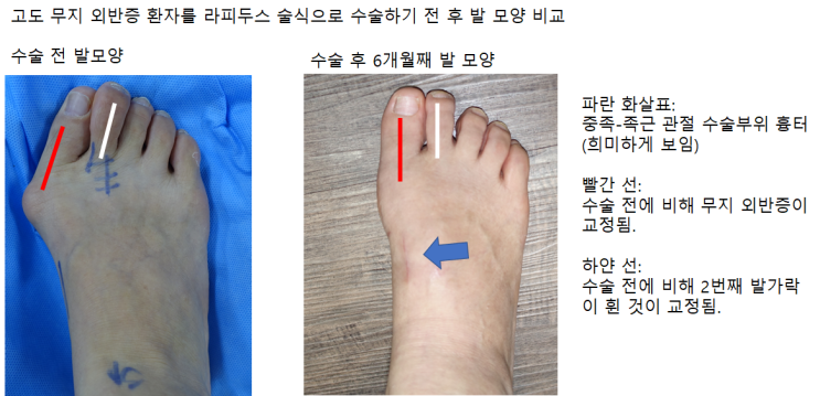 고도 무지외반증의 실제 치료 사례 중증 무지외반증 때문에 휜 두번째 발가락도 교정이 되나요 라피두스 술식 수술 실제 치료