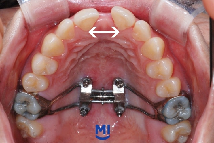 악궁확장장치 MARPE, RPE와는 어떤 차이가 있나요? : 네이버 블로그