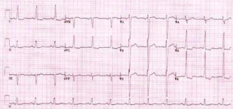 급성관상동맥증후군(ACS) 응급실 진단과 CCS(Canadian Cardiovascular Society) 분류 : 네이버 블로그