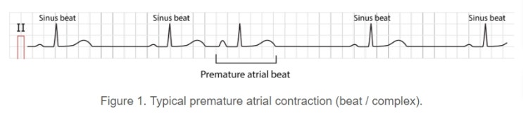 폐성 P, P pulmonale [심전도, EKG(ECG)] : 네이버 블로그