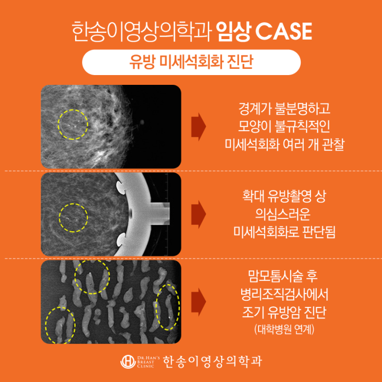 증상 없는 초기 유방암 모양 유방 석회화 네이버 블로그