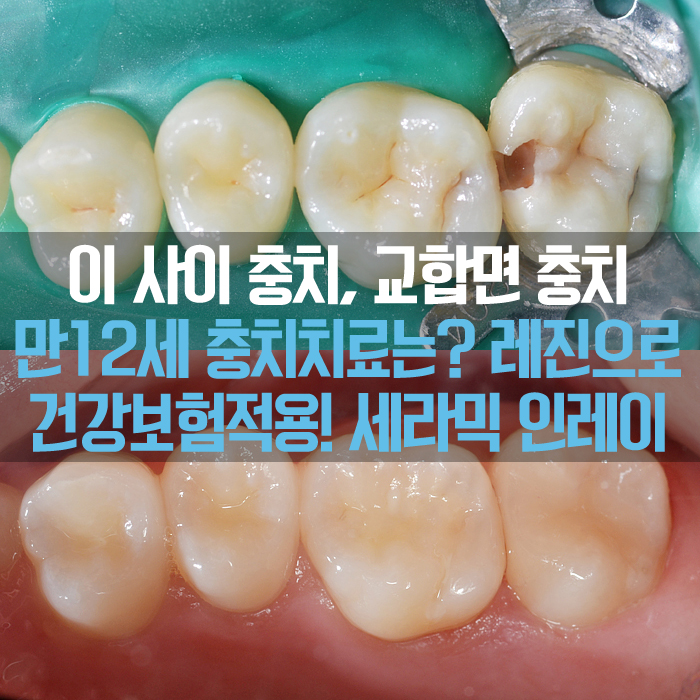 대구충치치료 이사이충치교합면 충치 Ez Print와 레진으로 치아형태재현 세라믹인레이 광중합형레진 만12세 건강보험