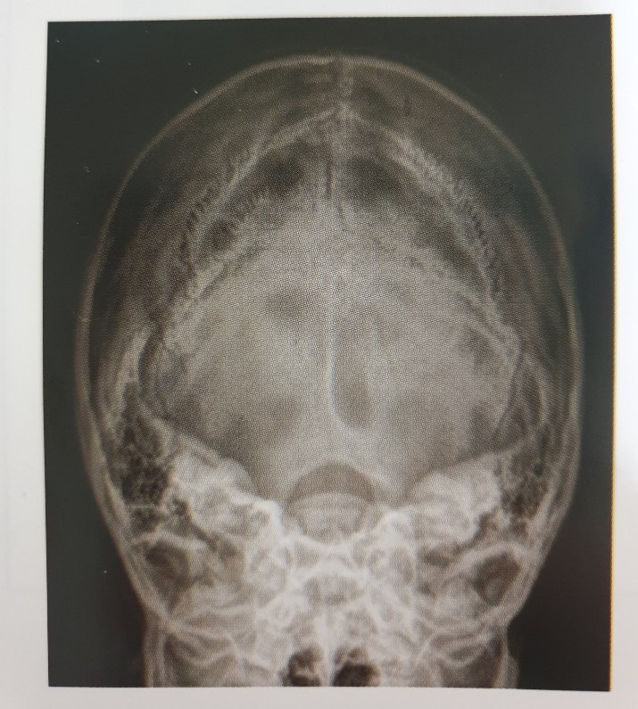 skull AP axial projection = Towne법 : 네이버 블로그