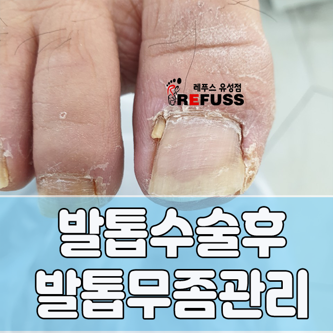 대전 내성발톱 수술 후 발톱무좀 생겨 관리받으셨어요 네이버 블로그