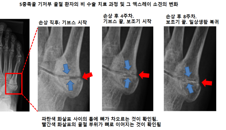 제 5 중족골의 기저부 골절 비수술적 치료 뼈가 부러졌다는데 디뎌도 된다구요 5 중족골의 비 수술적 치료 실제 사례 및 그