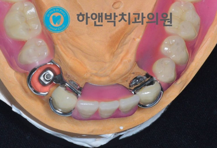 IARPD(Implant Assisted RPD) / 임플란트를 이용한 가철성 국소의치 / 임플란트 국소의치 / 임플란트 틀니 ...