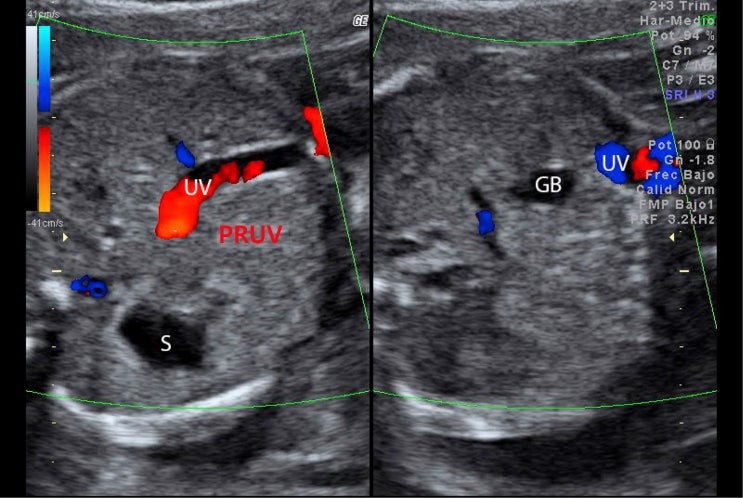 우리 아기 우측 제대 정맥이 잔존(PRUV) 해서 이상이라는데? : 네이버 블로그