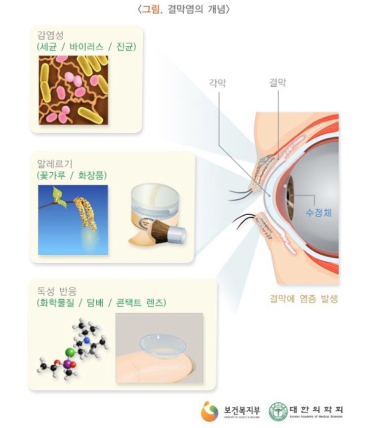 아기 유아 결막염 증상 전염 치료 기간 예방방법 네이버 블로그