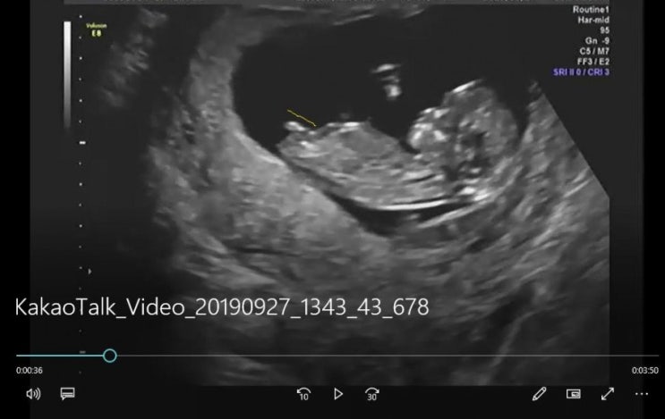 임신12주 각도법 딸 각도법 태아 각도법 적중률100 20191026 둘째성별확인 네이버 블로그
