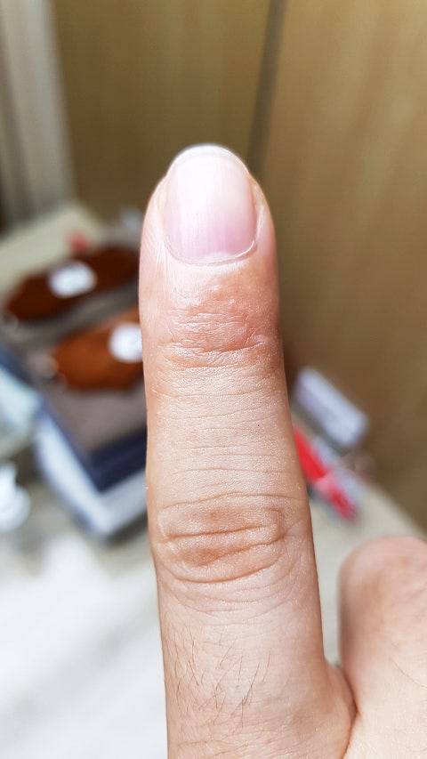 손가락 습진 한포진 연고 알리톡도 소용없다 이젠 자연치료 되길 바라며 네이버 블로그