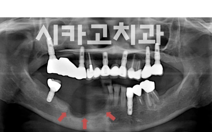 [흥덕지구치과] 골다공증약 복용시 치과치료 (BRONJ / MRONJ) [수원,영통,광교,용인,흥덕지구 치과 - 유앤아이시카고 ...