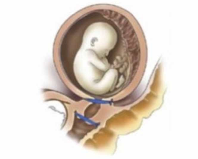 임신 19주 조기진통 배뭉침 자궁수축 자궁경부길이짧음 맥도날드수술 응급맥수술 맥수술 통증 맥수술 회복기간