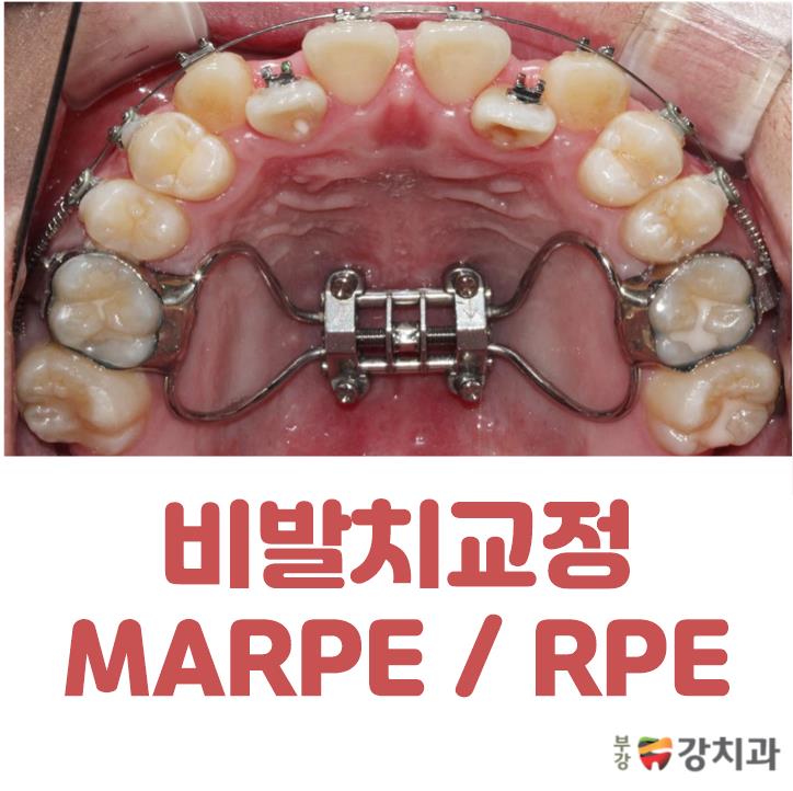 비발치교정에 사용되는 악궁확장장치 MARPE / RPE = MSE : 네이버 블로그