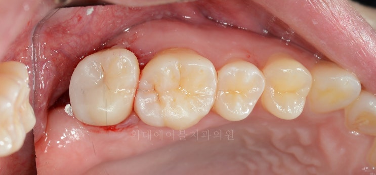 사랑니의 충치 그리고 사랑니 앞 치아의 충치 네이버 블로그