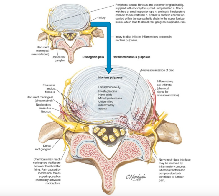 IDD(Internal Disc Disruption) : 네이버 블로그