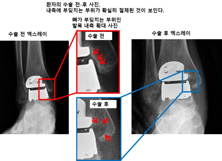 발목 인공 관절 수술 후 통증 발목 인공 관절 수술은 잘 되었다는데 왜 계속 아프죠 관절경적 골극 제거 수술 실제 사례