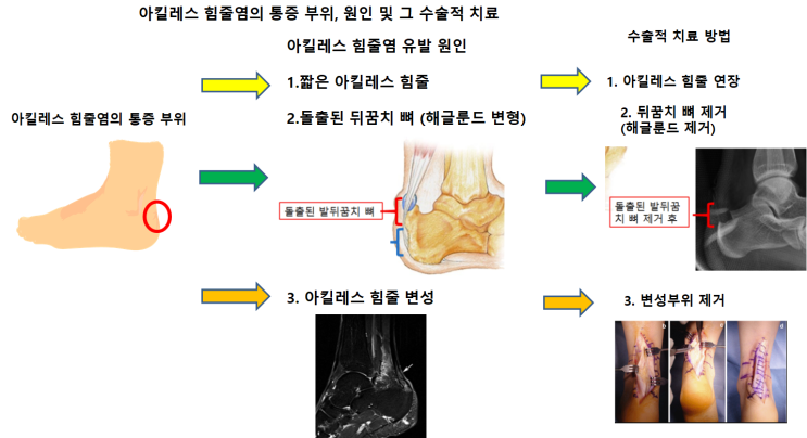 아킬레스 힘줄염의 수술 치료 운동할 때 뒤꿈치가 아파요 아킬레스 연장 해그룬드 및 힘줄 변성 부위 제거 수술 실제 사례