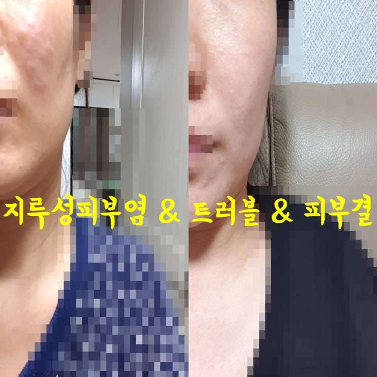 예작화장품 지루성 피부염 And 스테로이드 리바운드 현상 And 좁쌀 트러블 And 피부결 개선 네이버 블로그